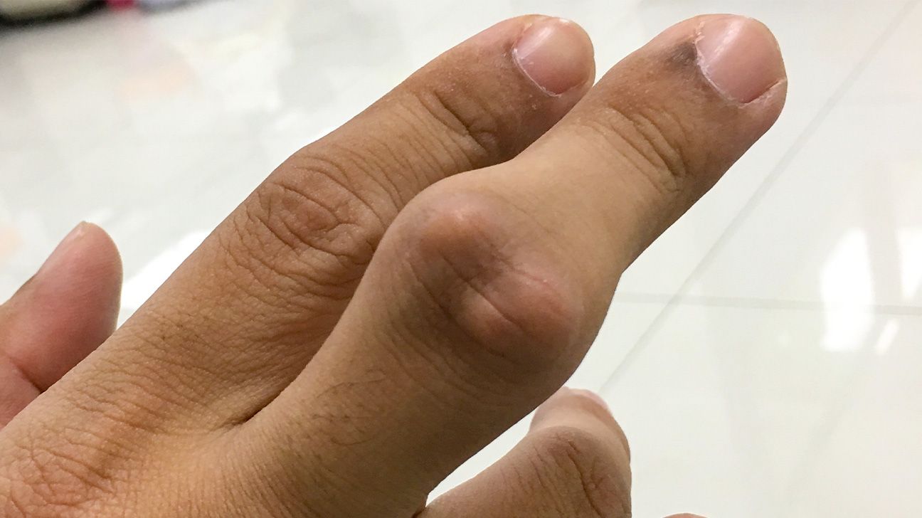 Causes Of Gout In Hands