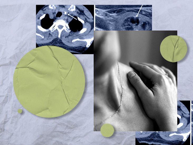 Thyroid nodules: Symptoms, treatment, causes, and pictures