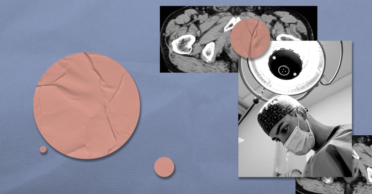 Inguinal Hernia Repair Surgery Types Risks Complications