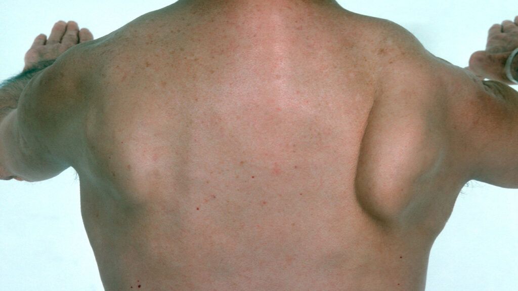 Scapular winging: Symptoms, treatments, and exercises