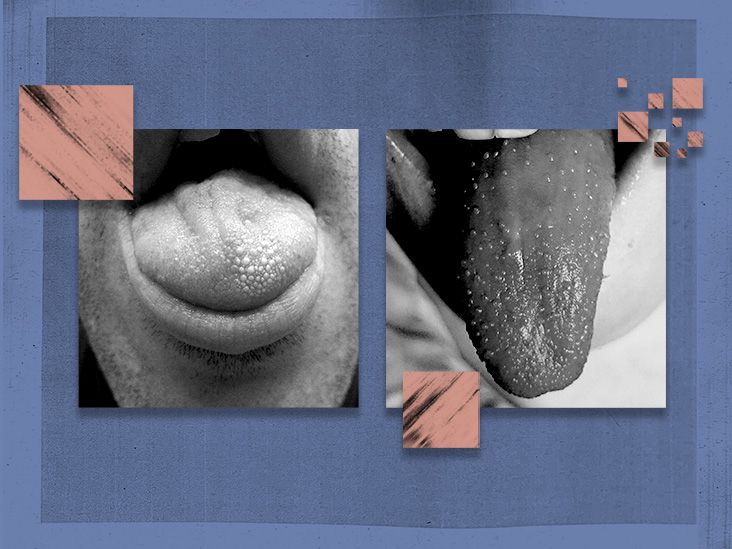 Spots on tongue: Causes and when to see a doctor