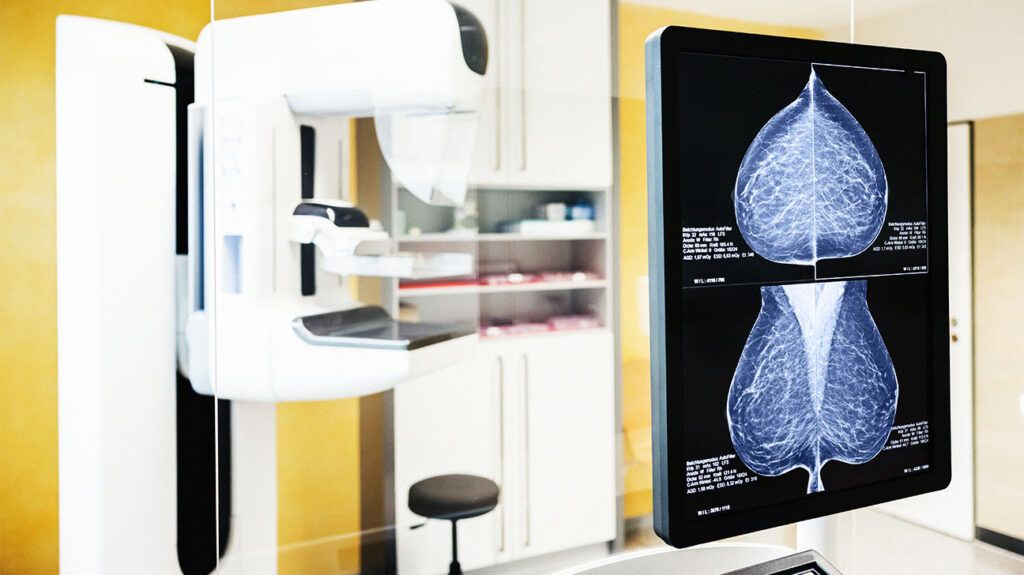 AI breast cancer detection: How can it help, and is it accurate?