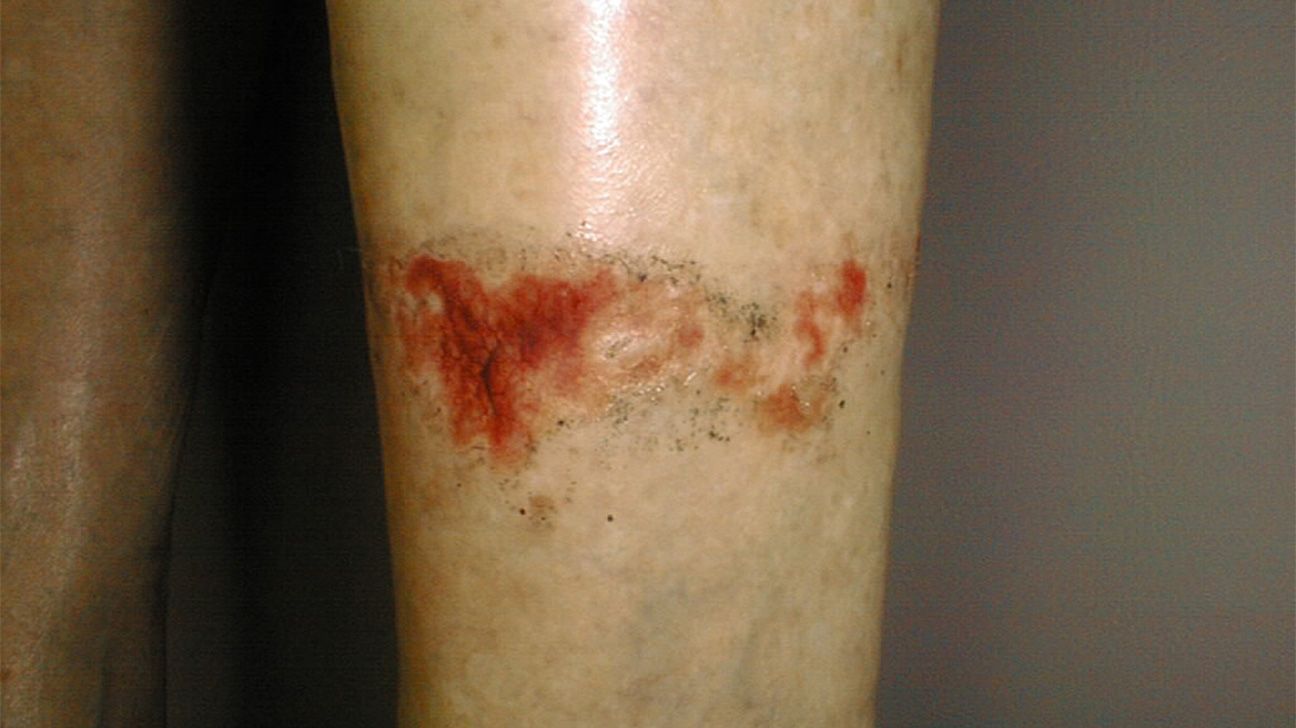 Lactic Acid Chemical Burn