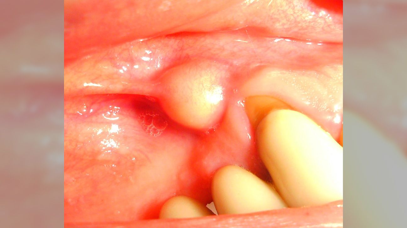 Abscess Gum Ulcer