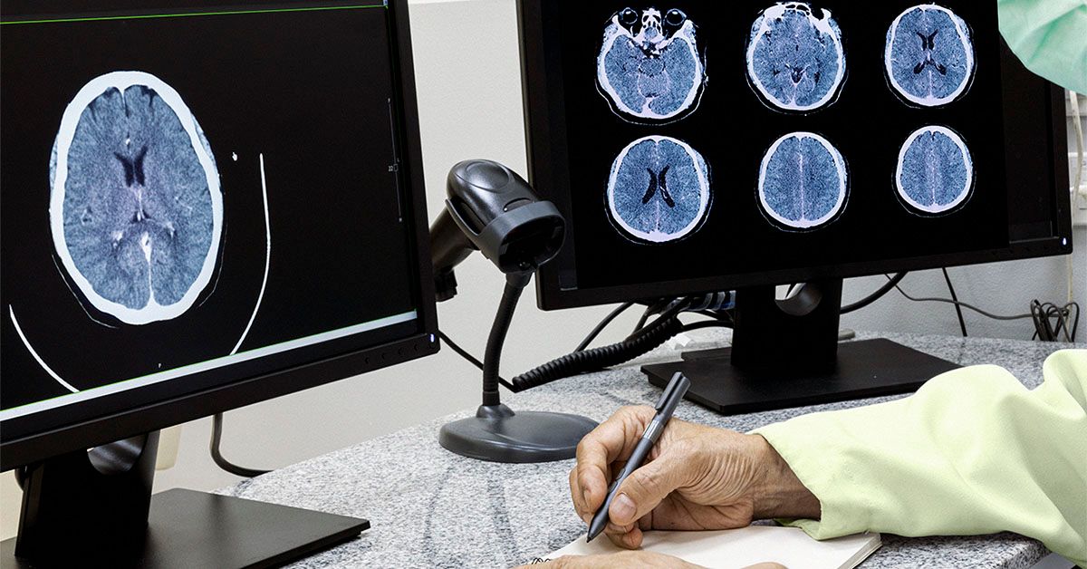 Cerebellar ataxia: Causes, symptoms, and treatments