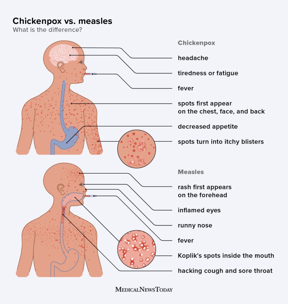 Measles Early Symptoms