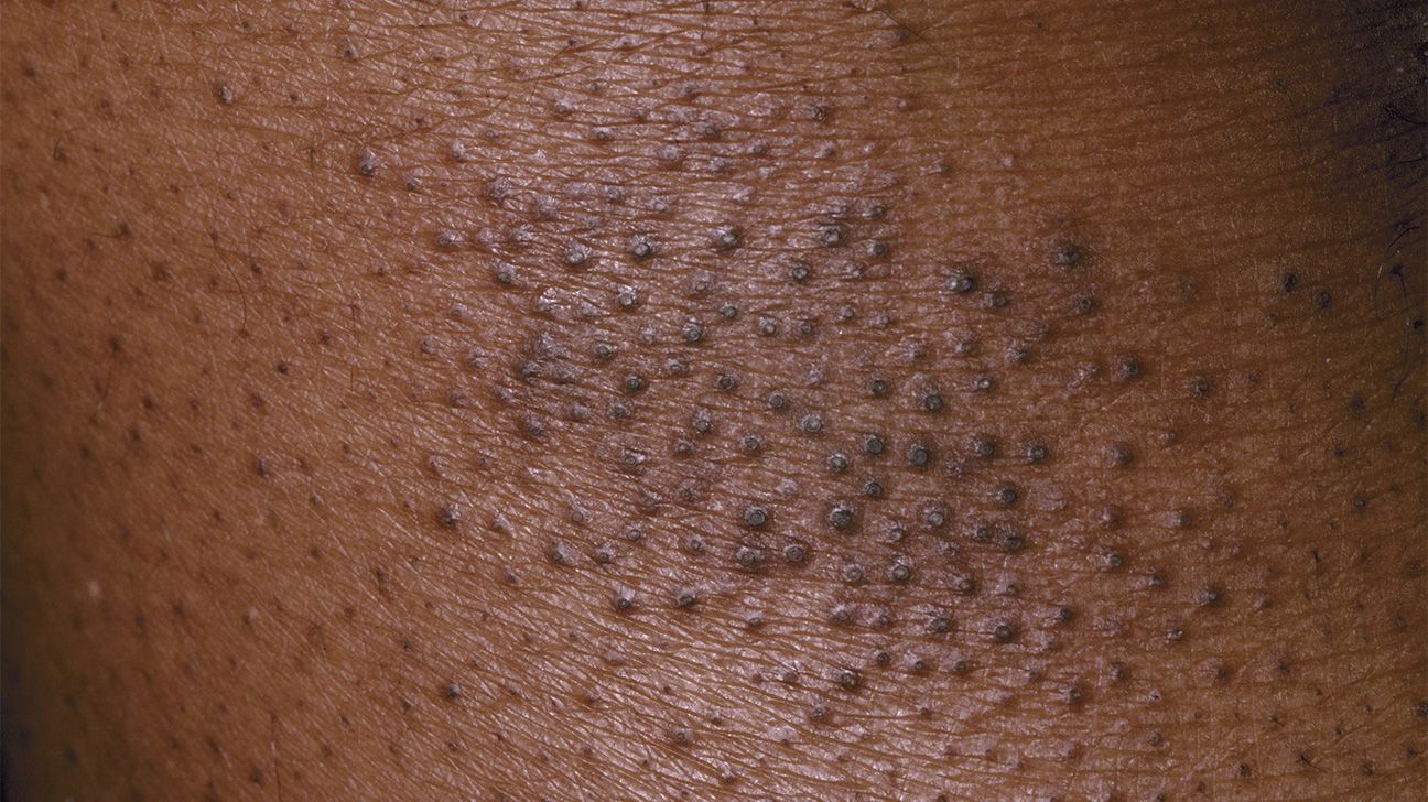Impetigo Diaper Rash Pictures Diaper Choices