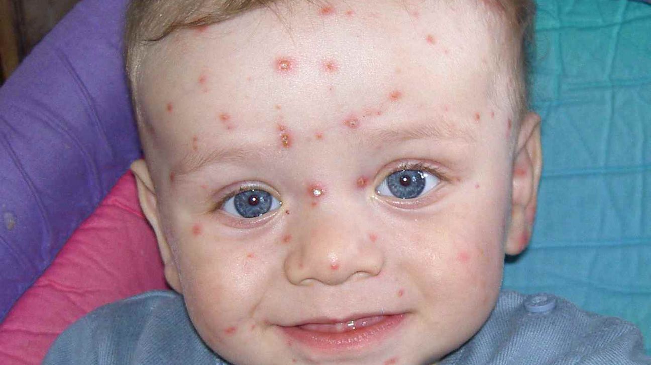 Chicken Pox On Face First