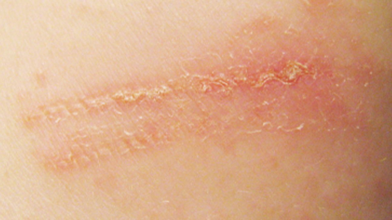 Bacterial Vaginosis Bumps