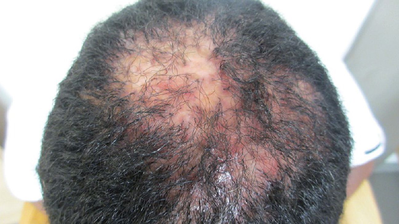 Folliculitis Scalp African American