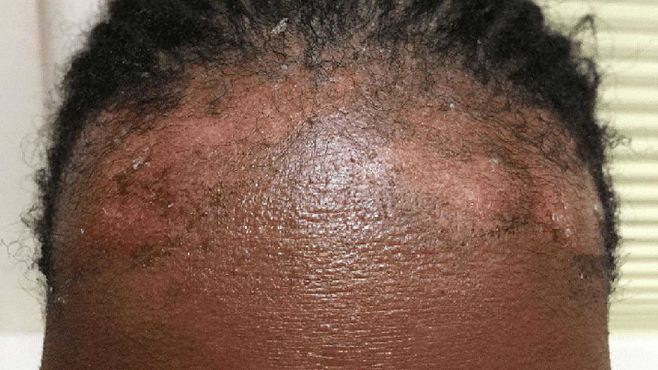 What Are The Brown Crusty Spots On My Scalp - Infoupdate.org