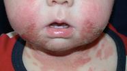 Face Rash With Blisters Face Rash With Blisters