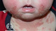 What Causes Rash Around Mouth In Babies Infoupdate What Causes Rash Around Mouth In Babies Infoupdate