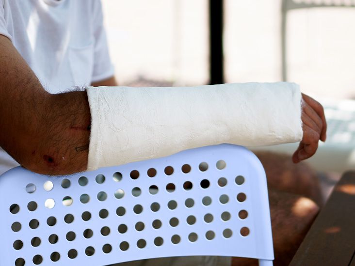 Cast rubbing on skin: What to do, pain relief tips & more