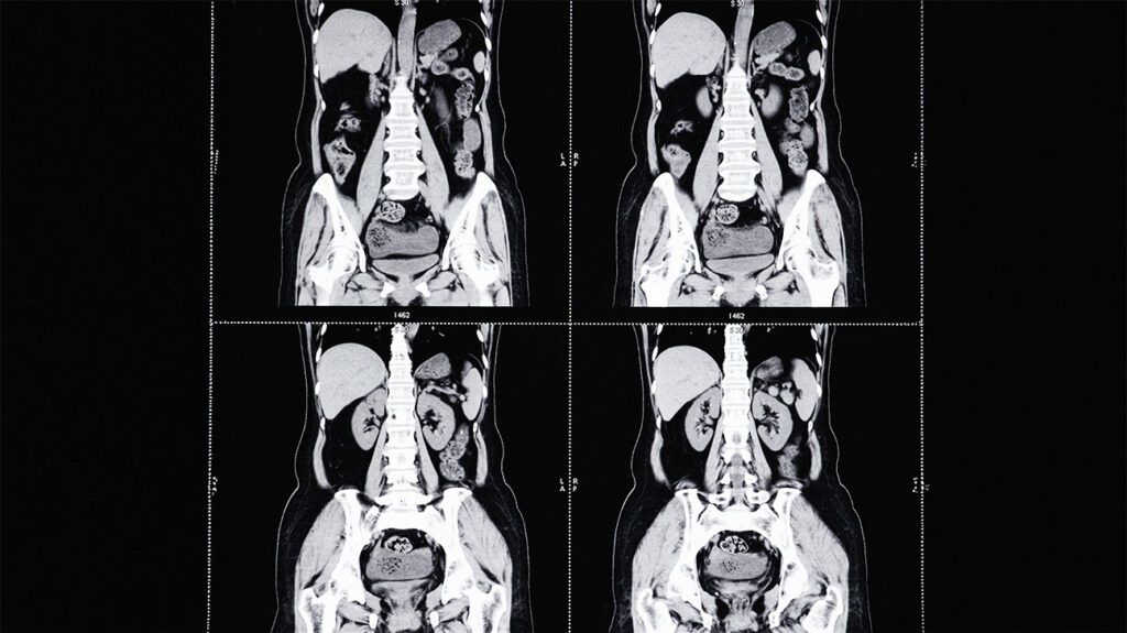 Hepatomegaly (enlarged liver): Symptoms, causes, and treatment