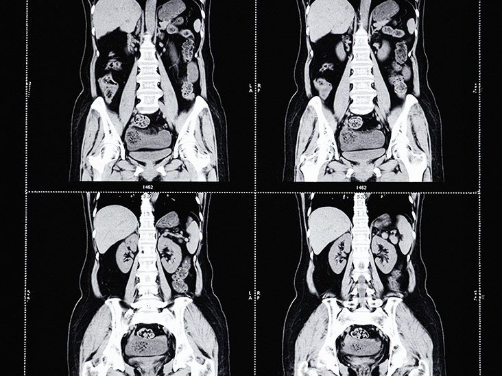Enlarged Liver What Is Hepatomegaly Youtube