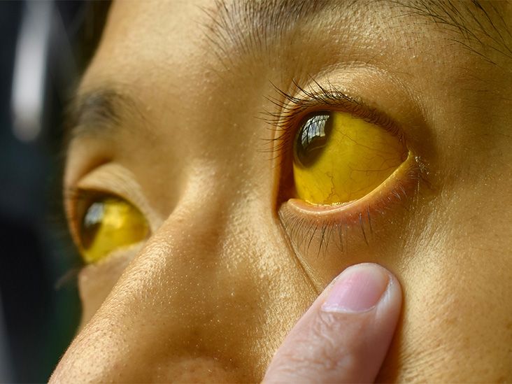 What Color Is Urine With Pancreatic Cancer - Infoupdate.org