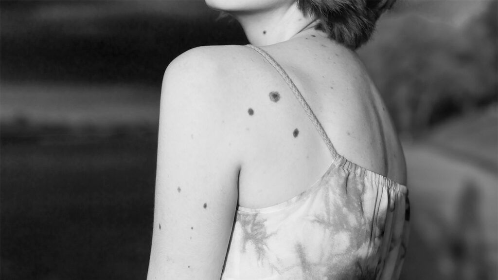 Itchy mole: Causes, treatment, and symptoms