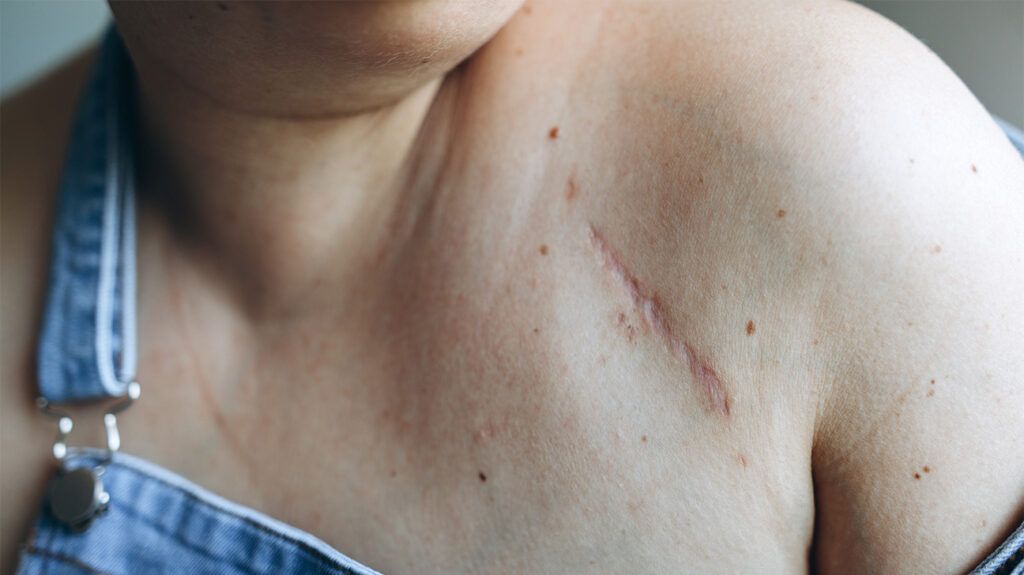 Skin cancer in scars