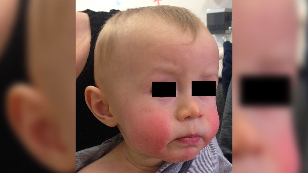 Bacterial Rash On Face Skin Rashes & Conditions | Types & When To