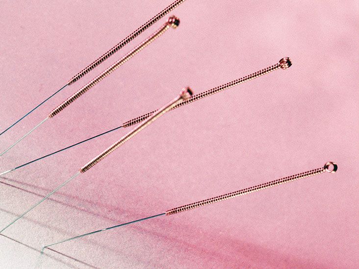 What is dry needling and what are its benefits and risks?