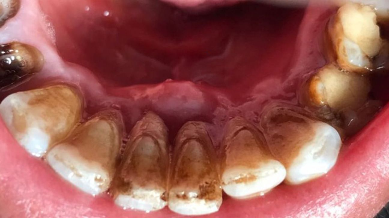 Abscessed Front Tooth