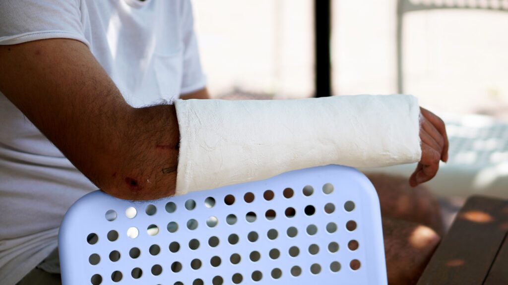 Cast rubbing on skin: What to do, pain relief tips & more