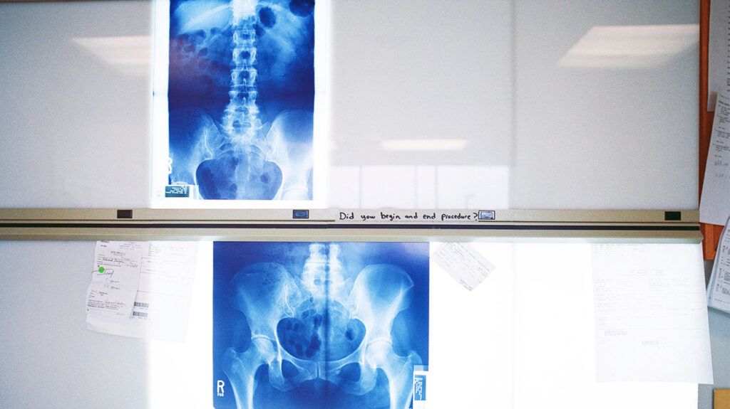 Lordosis vs. Hyperlordosis: A guide to spinal curvature