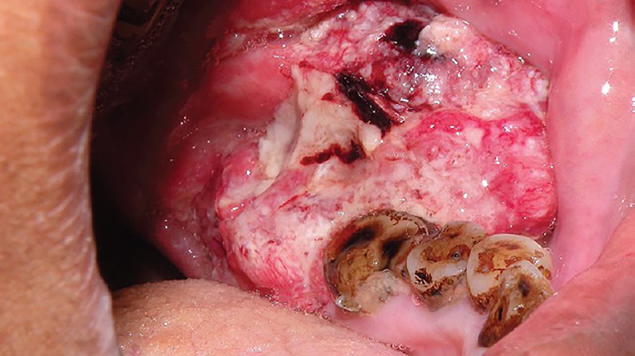 Lingual Tonsils Cancer