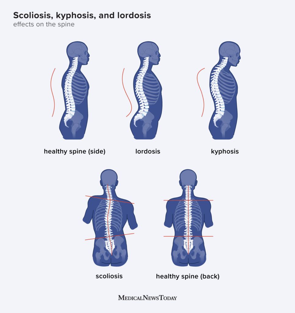 Scoliosis, kyphosis, and lordosis: Key differences