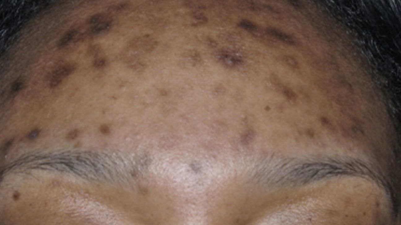 Types Of Pigmentation Disorders - Infoupdate.org
