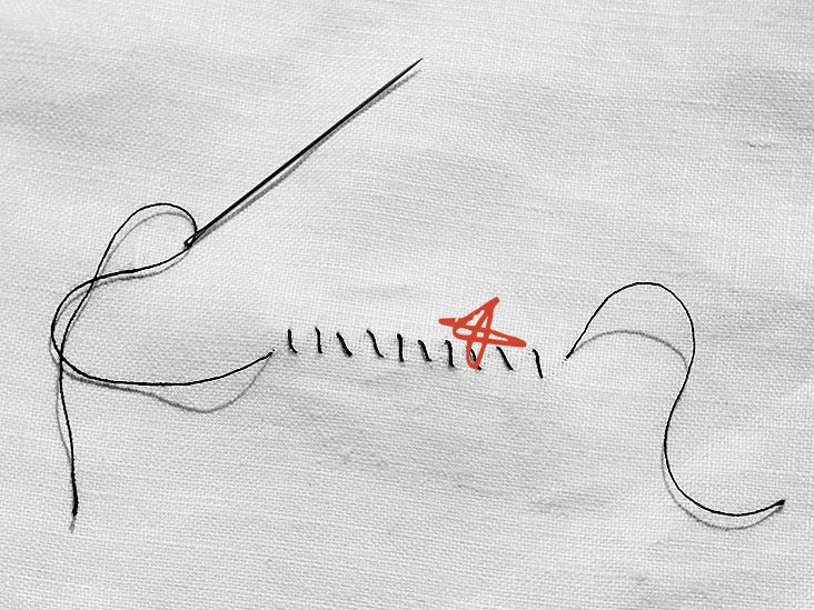 Infected stitches: Symptoms, treatments, and more