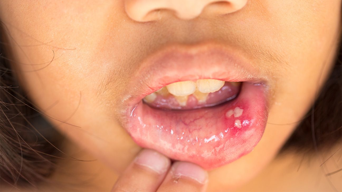 Canker Sores On Outside Of Lips