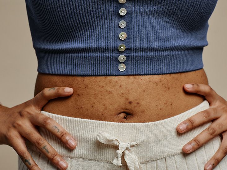 Pimple on stomach: Causes, treatment, and prevention