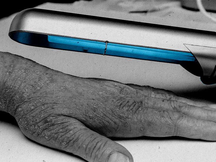 Tratamientos para el eczema severo