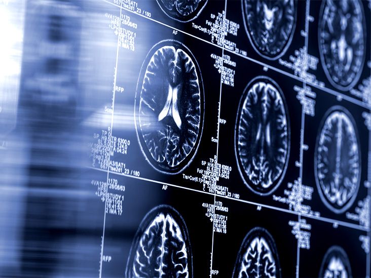 AI-driven stroke tool shows improved outcomes in major clinical trial