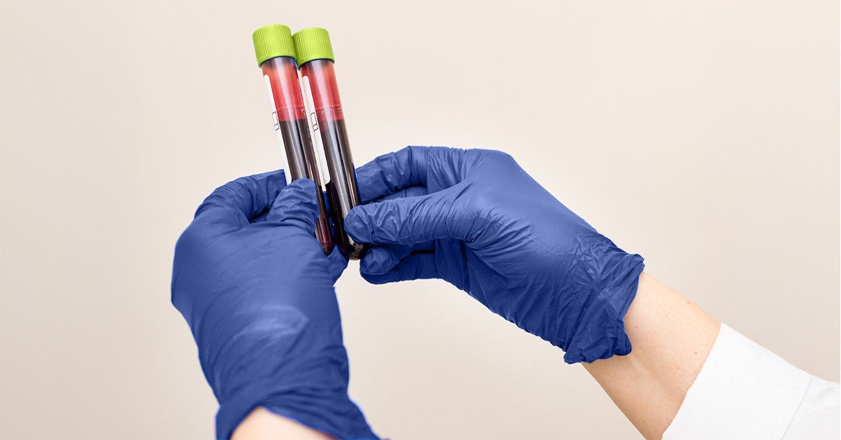 Alzheimer's biomarker blood tests may help detect very early signs