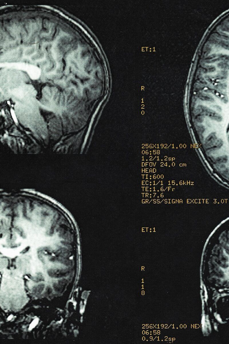 Structural Brain Differences for Transgender People