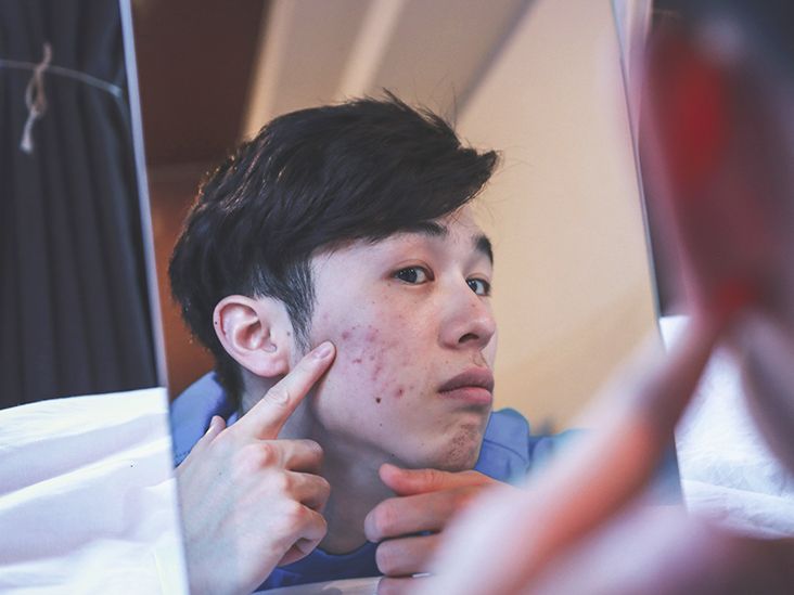 Stress Acne: Why It Happens and What to Do