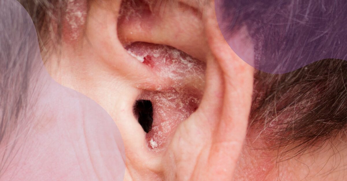 Psoriasis in Ears: Symptoms, Causes, Treatments, and More