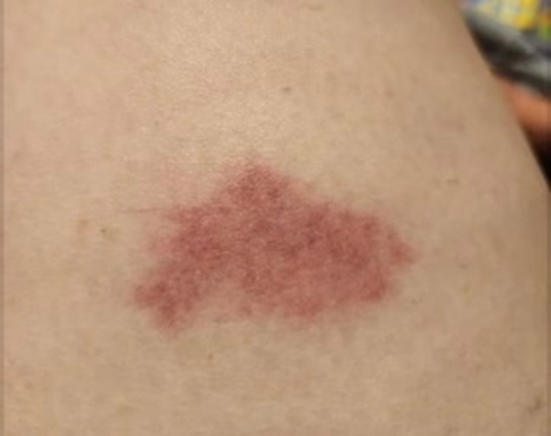 Rheumatoid Arthritis: Rashes and Skin Changes