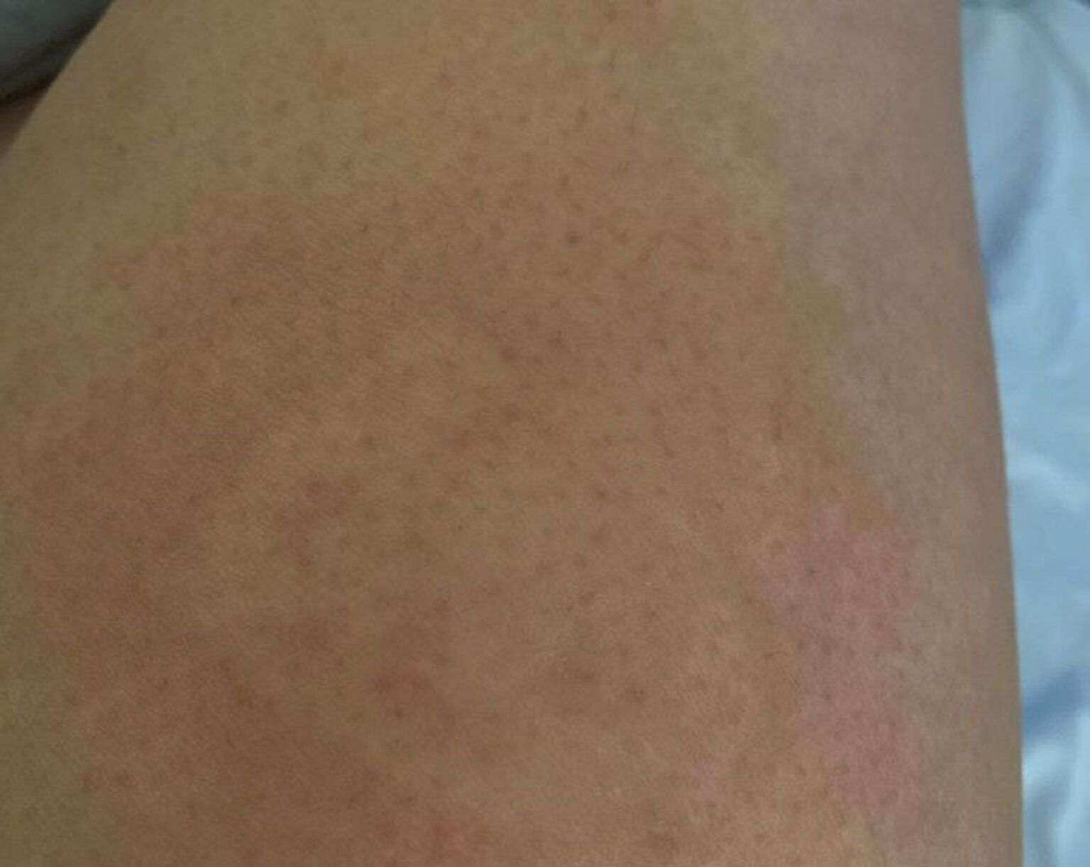 Rheumatoid Arthritis: Rashes and Skin Changes