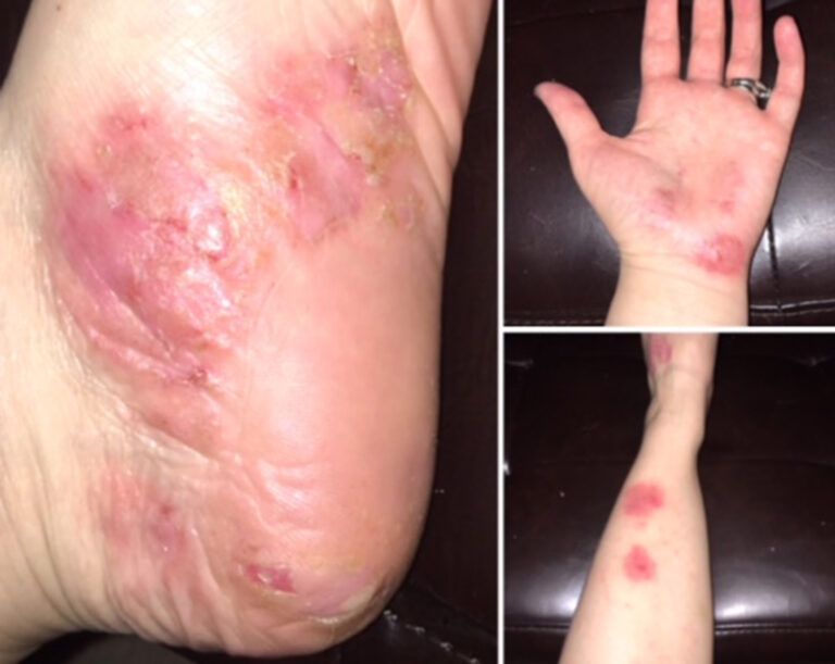 Rheumatoid Arthritis: Rashes and Skin Changes