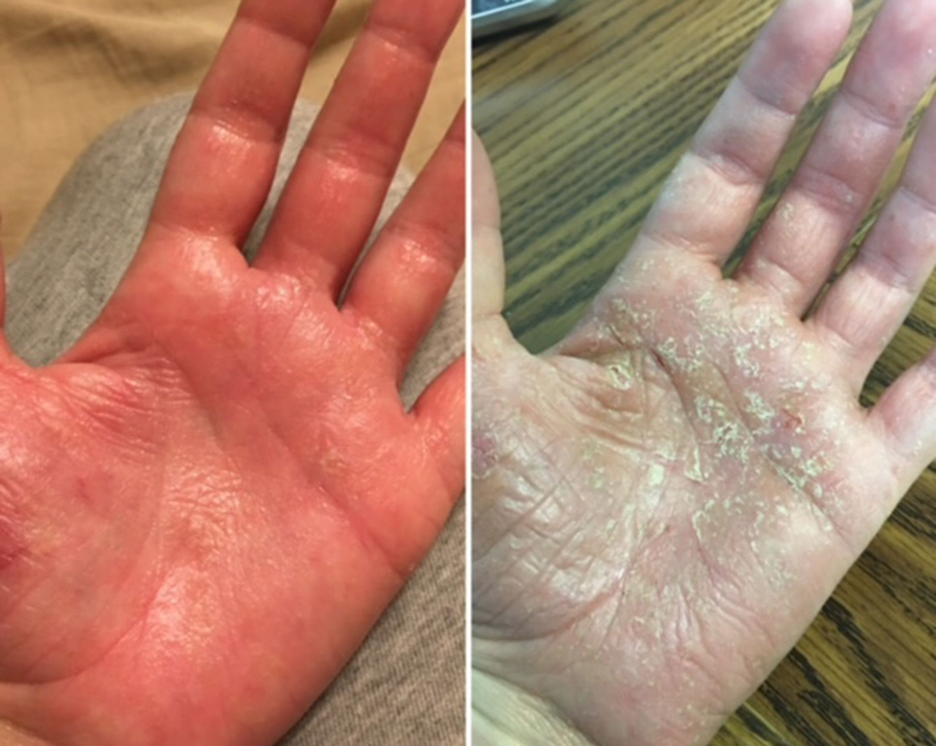 Rheumatoid Arthritis: Rashes and Skin Changes