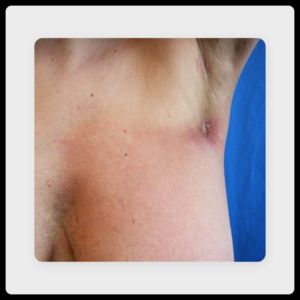Breast Cancer Radiation Burns: How to Treat and What They Look Like