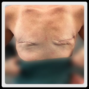 What It Looks Like: Double Mastectomy to Flat Aesthetic Closure
