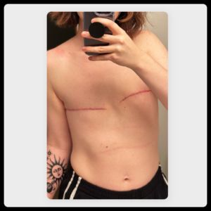 What It Looks Like: Double Mastectomy to Flat Closure with Tattoos