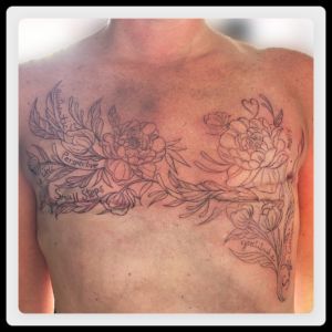 What It Looks Like: Double Mastectomy to Flat Aesthetic Closure