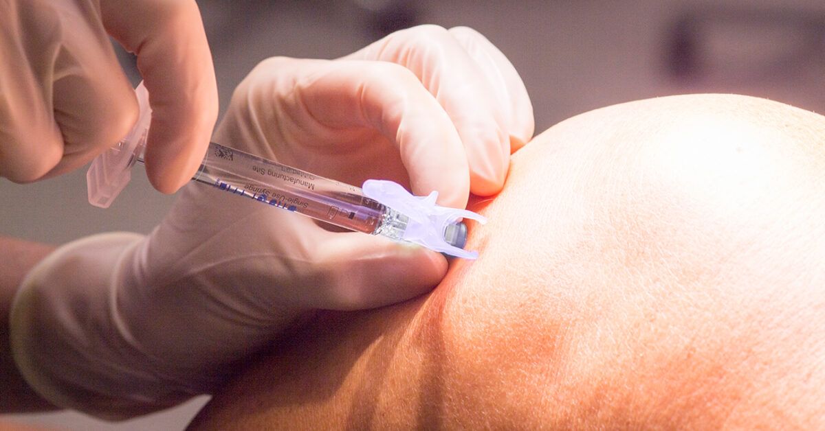 Hyaluronic Acid Injections for Rheumatoid Arthritis