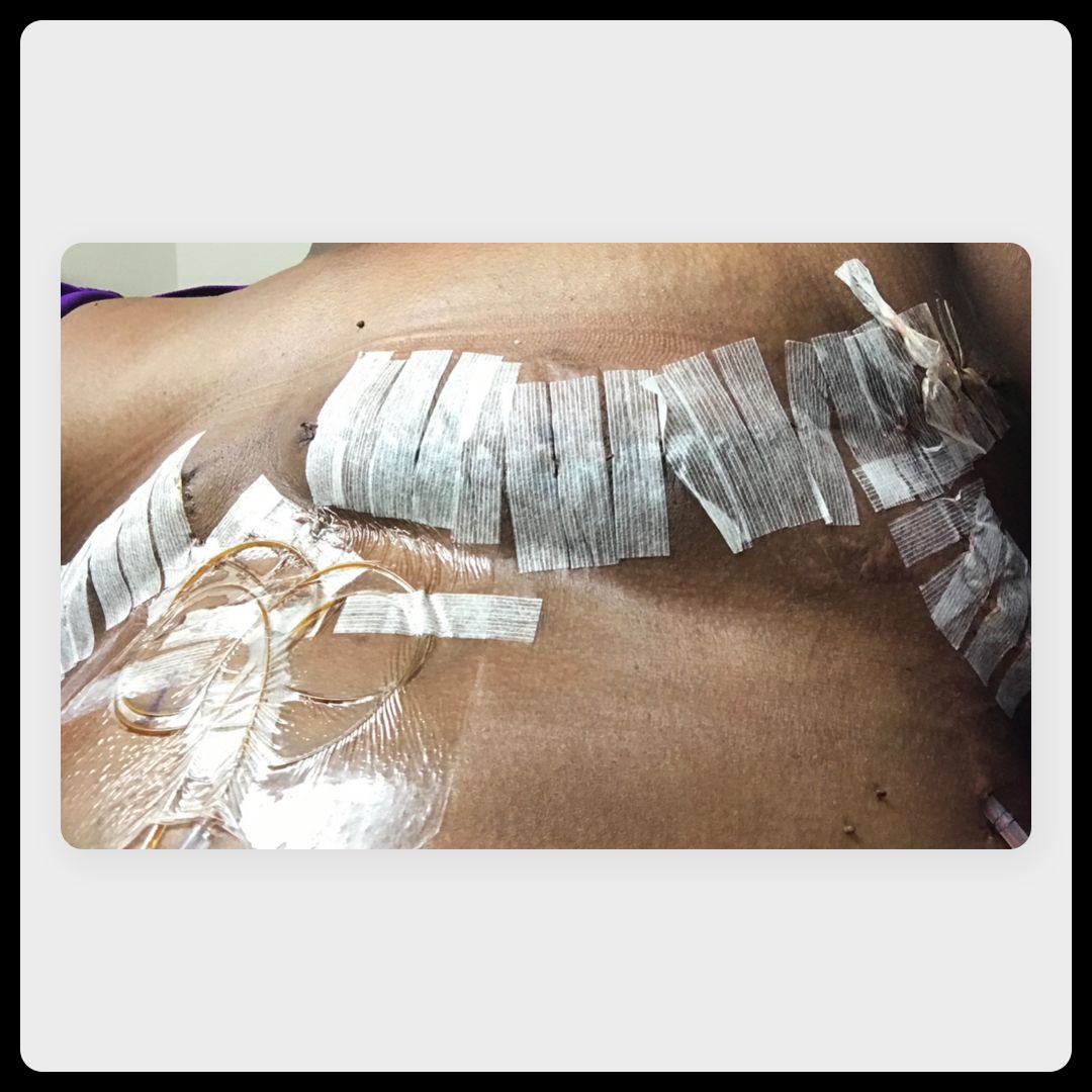 Gained More Than I Lost: Double Mastectomy to Explant and Flat Closure